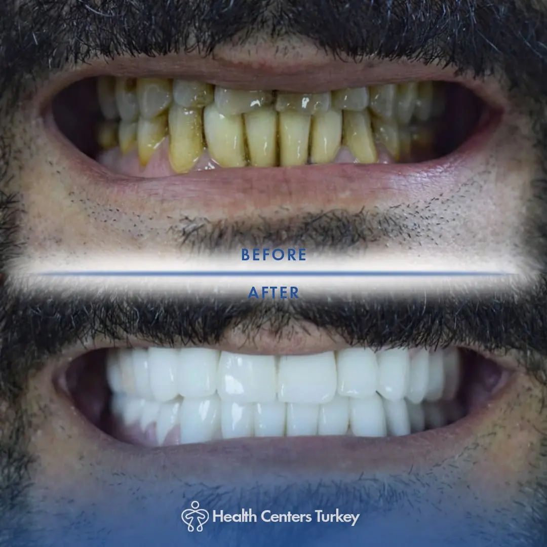 Full Mouth Dental Implants in Turkey Package Deals & Cost