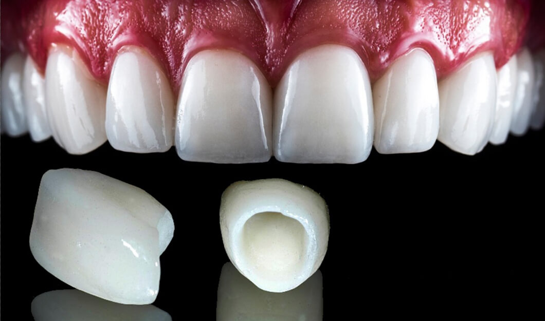 E-Max Veneers Cost Turkey Per Tooth - Health Centers Turkey