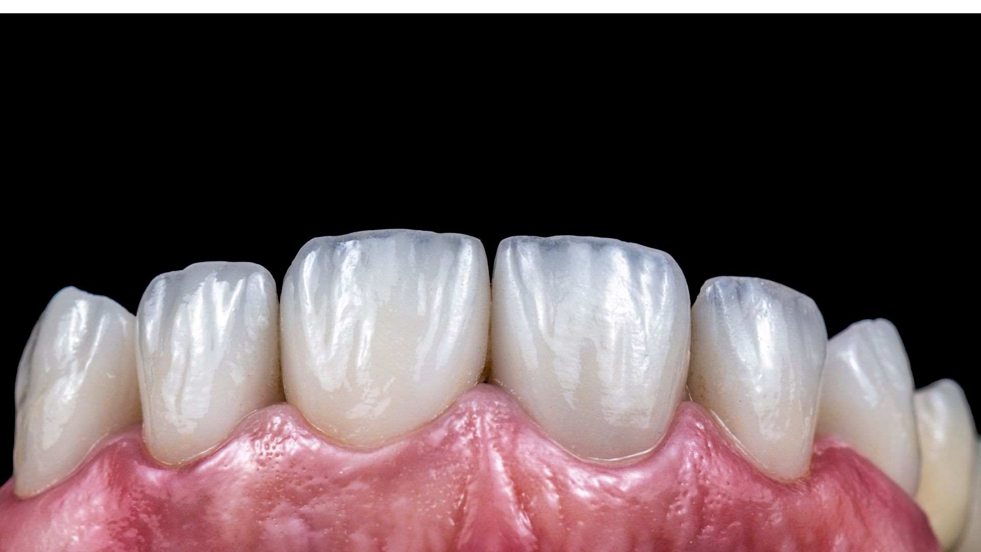 E-Max Veneers Cost Turkey Per Tooth - Health Centers Turkey